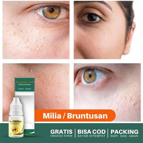 Jual Obat Penghilang Milia Bintik Putih Di Bawah Mata Bruntusan Di