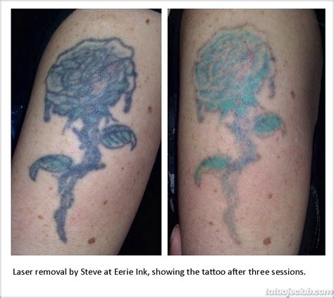 Es peligroso quitar un tatuaje láser peligros y efectos secundarios de