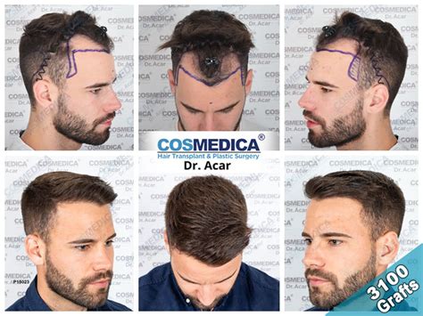 Trapianto Capelli Prima E Dopo Clinica Cosmedica Dr Acar