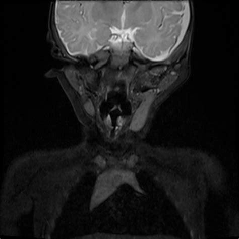 Ectopic Thymus Image Radiopaedia Org