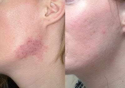 Vascular Birthmarks And Port Wine Stains Gateway Aesthetic Institute