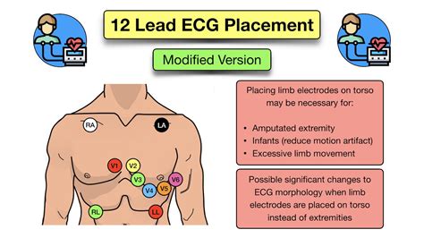 Lead Ecg Placement Diagram And Mnemonic For Limb And Off