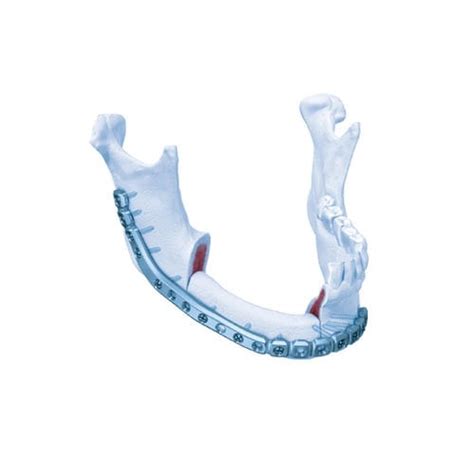 Placa de compressão óssea para mandíbula MatrixMANDIBLE Depuy