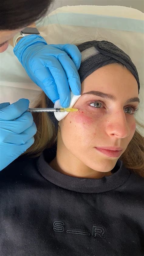 PRP Under Eye Treatment Professionals In Melbourne Plasma Therapy