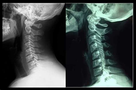 GUÍA COMPLETA Latigazo cervical diagnóstico y tratamiento