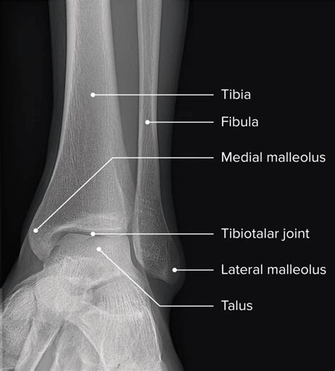 Articulaci N Del Tobillo Anatom A Concise Medical Knowledge