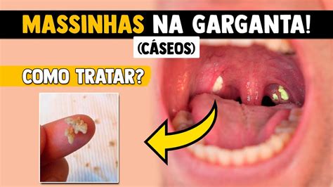 Massinhas Fedidas Na Garganta Caseo Amigdaliano Como Se Livrar