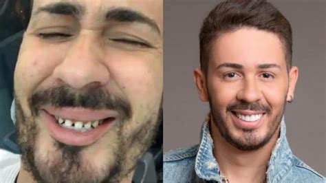 Famosos Chocam Fotos Antes De Lentes Nos Dentes
