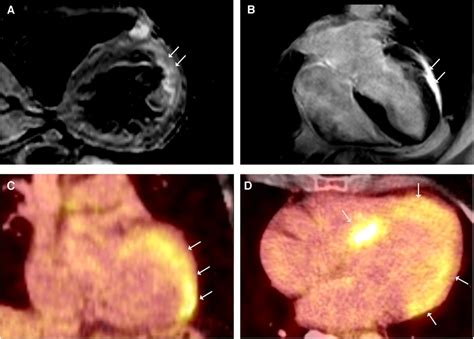 Frontiers Case Report Four Cases Of Cardiac Sarcoidosis In Patients