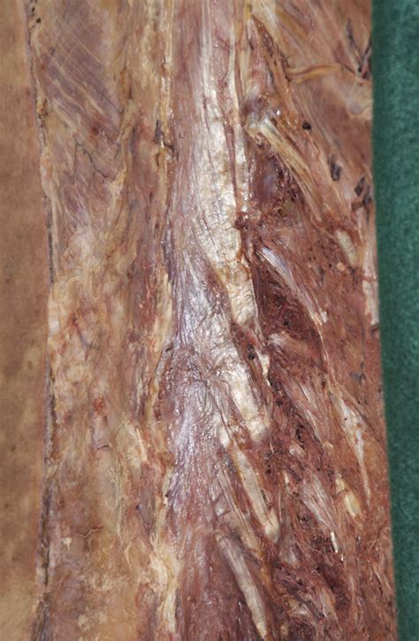 Erector Spinae Muscles Cadaver