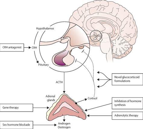 Congenital Adrenal Hyperplasia The Lancet