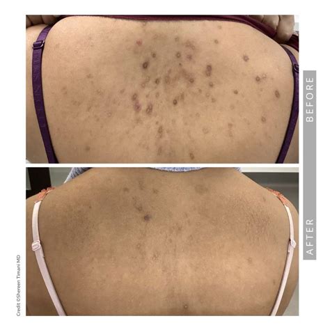 Chemical Peels Springs Dermatology Md Springs Dermatology Md