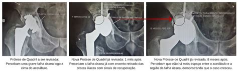 Prótese se Quadril Revisado grave falha óssea logo a cima do