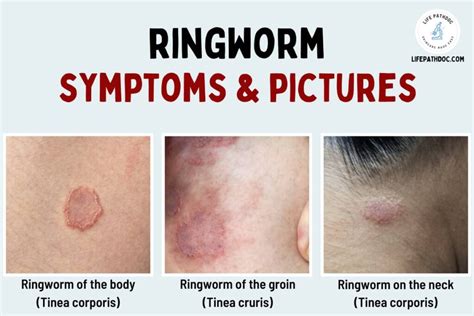 Ringworm Pictures Symptoms What Does Ringworm Look Like