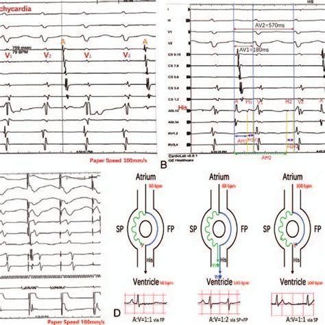 Continuous Intracardiac Electrogram Recorded By ICD And Surface ECG