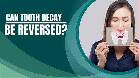 Can Tooth Decay Be Reversed YouTube