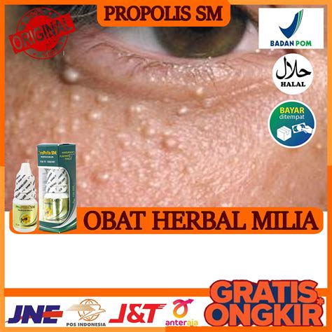 Jual Obat Alami Milia Bintik Putih Di Wajah Bruntusan Propolis Sm