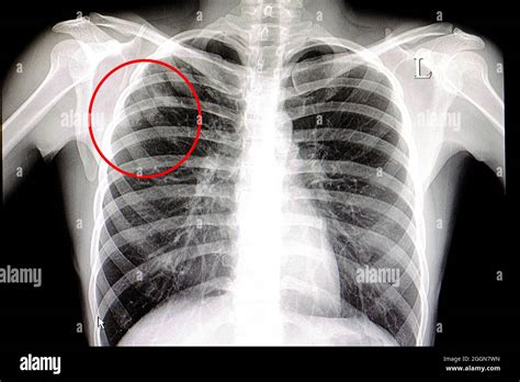 Normal Chest X Ray Vs Tb