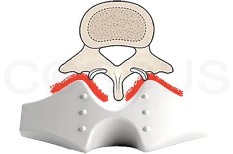 Corrige Hernias discales desde casa Cordus España