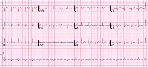 Dr Smith S ECG Blog Regular Wide Complex Tachycardia What Is The