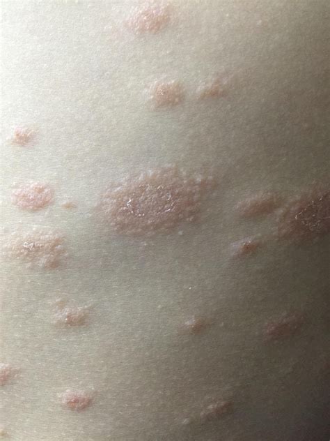 Pitiriasis Rosada Causas Estr S Porestr S