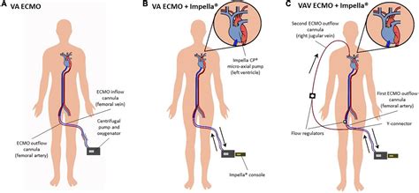 Va Ecmo Cannula Placement