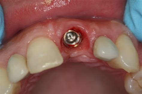 Pose D Implants Dentaires CRFI Clinique D Implantologie Qc