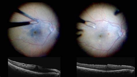 Tratamiento De Membrana Epirretiniana Centro De Retina Tijuana