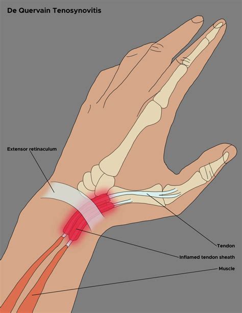 De Quervain Tenosynovitis Statpearls Ncbi Bookshelf