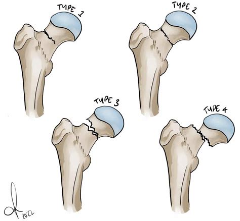 Hip Fracture Classification According To Garden A Pawels B