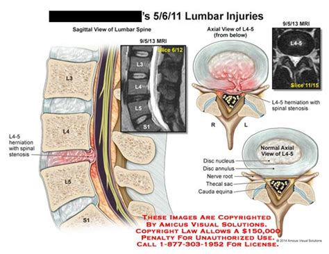 AMICUS Illustration Of Amicus Injury Lumbar Spine Spinal Cord Vertebrae