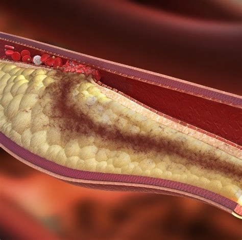 Dislipidemia Saiba O Que E Tipos Causas Sintomas E Tratamentos Eroppa