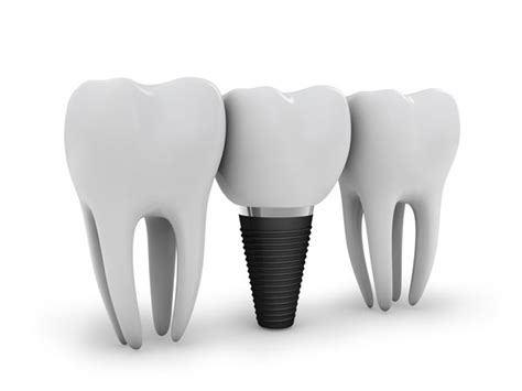 Implantes Dentales Ventajas E Inconvenientes
