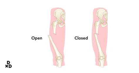 Open Vs Closed Fracture