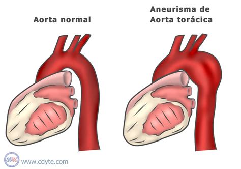 Aneurisma de Aorta Torácica AAT CDyTE