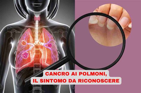 Cancro Ai Polmoni Il Sintomo Che Pochi Conoscono Prevenzione