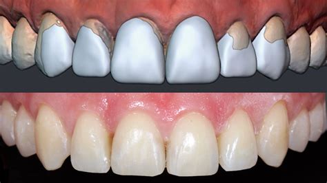 Curso de DISEÑO DE SONRISA DIGITAL con Blender for Dental