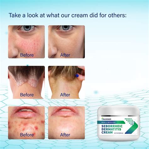 Seborrheic Dermatitis Cream Fast Acting Treatment For Face Scalp Folliculitis Dandruff