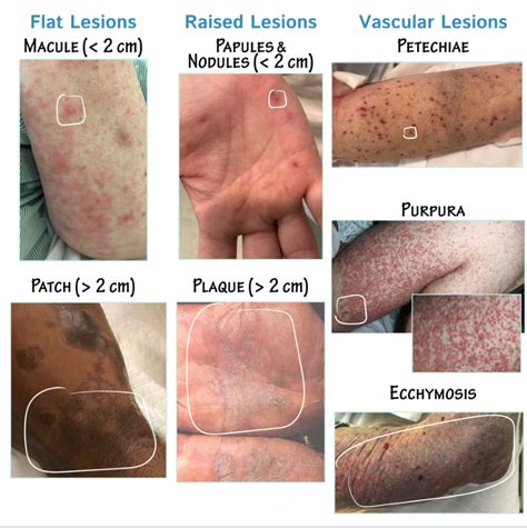 Clinical Pathology Glossary Common Dermatologic Findings Ditki