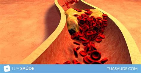 6 dicas para baixar os triglicerídeos altos Tua Saúde