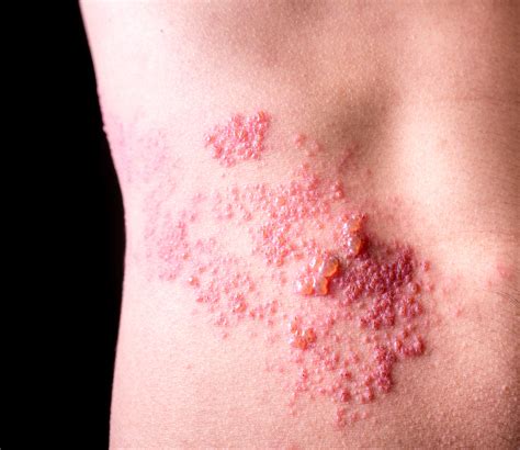Warning Signs Of Shingles Things Health