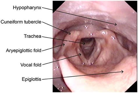 Frontiers Exercise Induced Laryngeal Obstruction Protocol For A