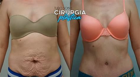 8 Lipoabdominoplastia Antes E Depois EmelMujtaba