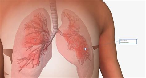 Premium Photo Bronchiolitis Is A Respiratory Condition In Which The