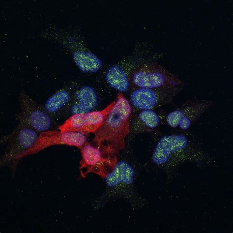 Cómo Una Proteína Favorece La Metástasis Del Cáncer De Mama