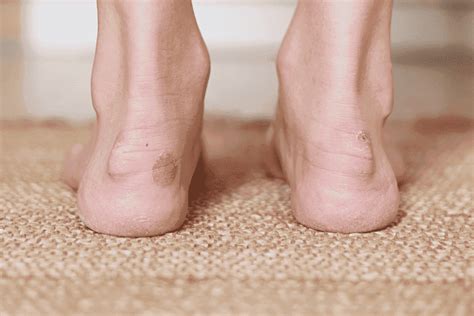 Ampollas en los pies en ancianos Cómo curarlas Aiudo Blog