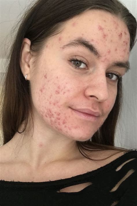 Back Acne Before And After Accutane