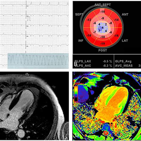 Multimodality Imaging Assessment Case 2 A Electrocardiogram Shows