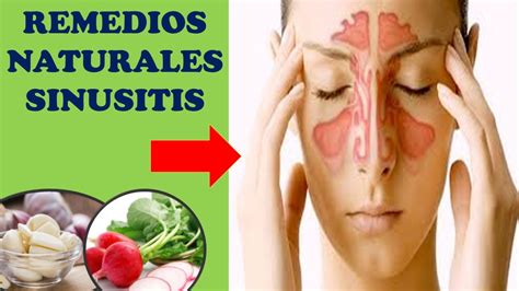 REMEDIOS CASEROS Y NATURALES PARA LA SINUSITIS YouTube