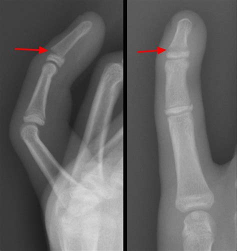 Growth Plate Fracture Causes Types Symptoms Treatment